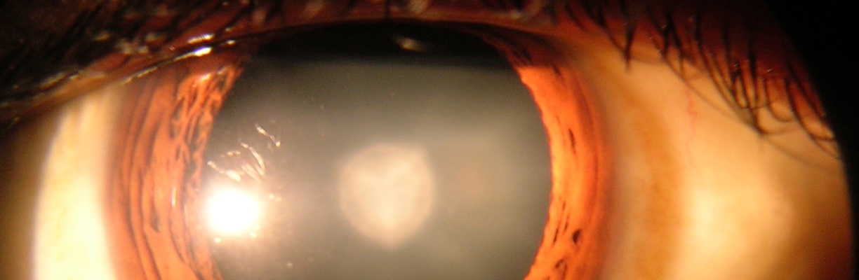 AI-based cataract screening app by TNeGA