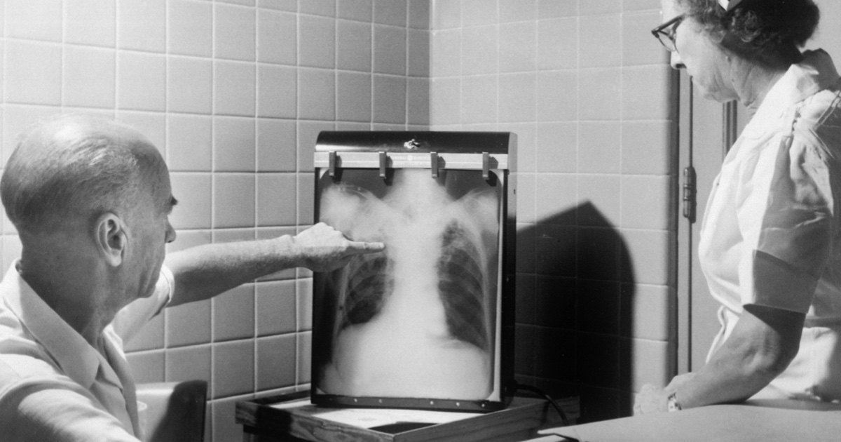 Deep Learning model detects abnormal lung findings